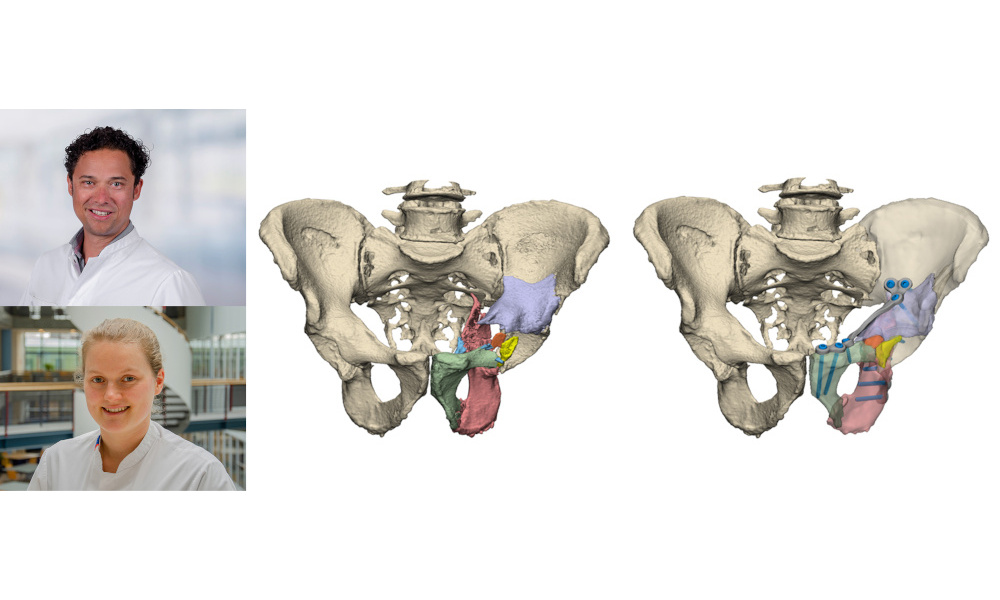 Publiekslezing: bekkenfractuur - behandeling met op maat gemaakte ...